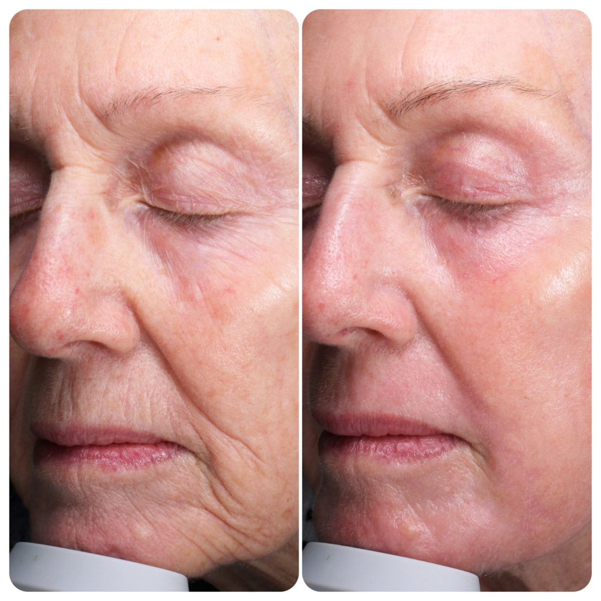 Laser Surgery - Toby Nelson Dermatology